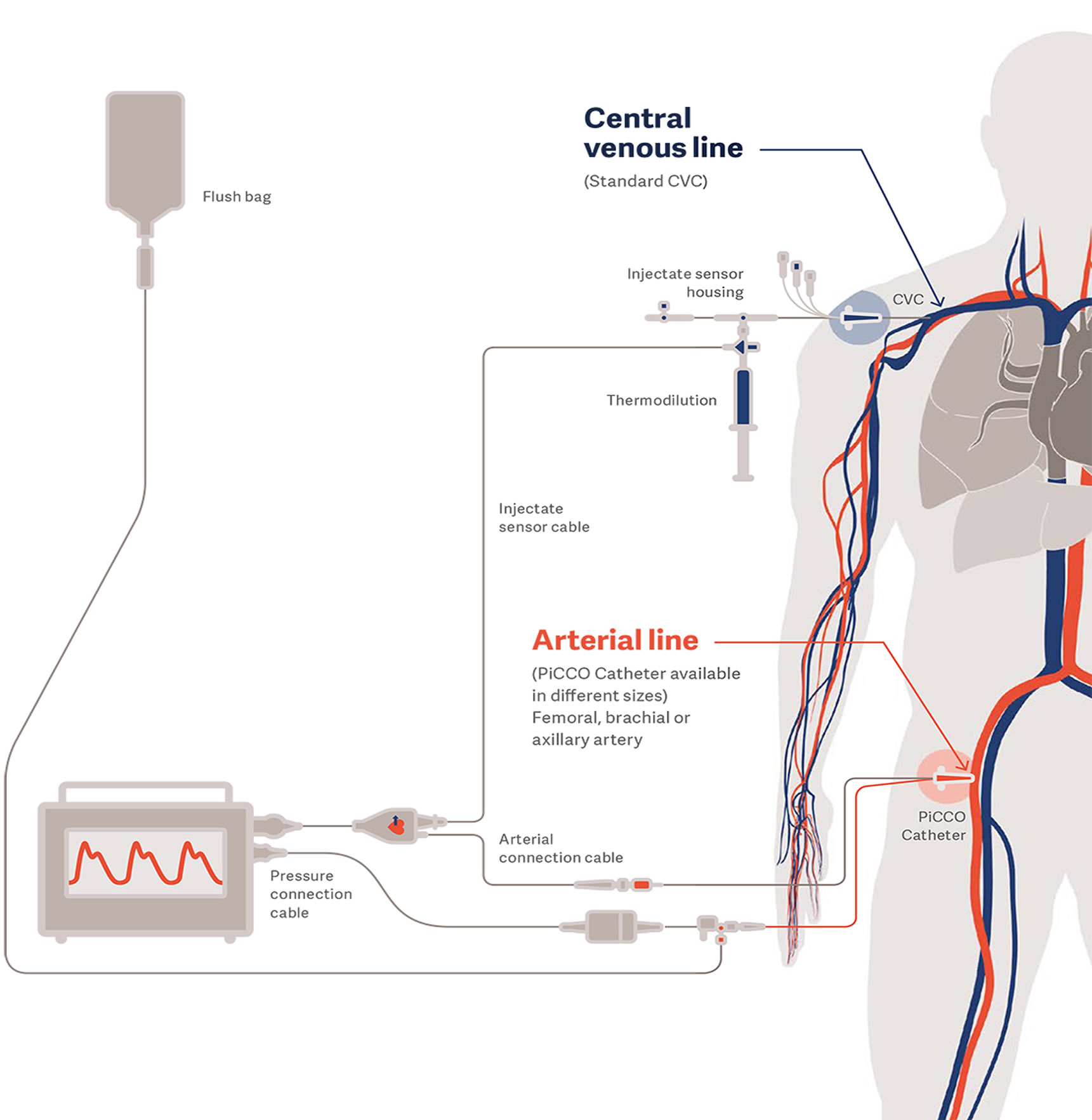 How to optimize PiCCO thermodilution measurements part01