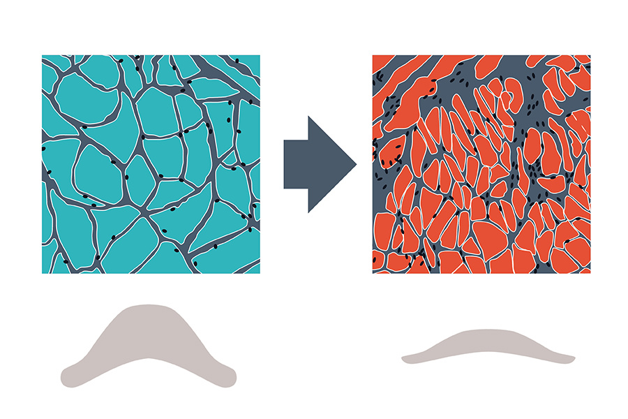 Neural Pressure Support (NPS) - Aide inspiratoire neurale - Getinge