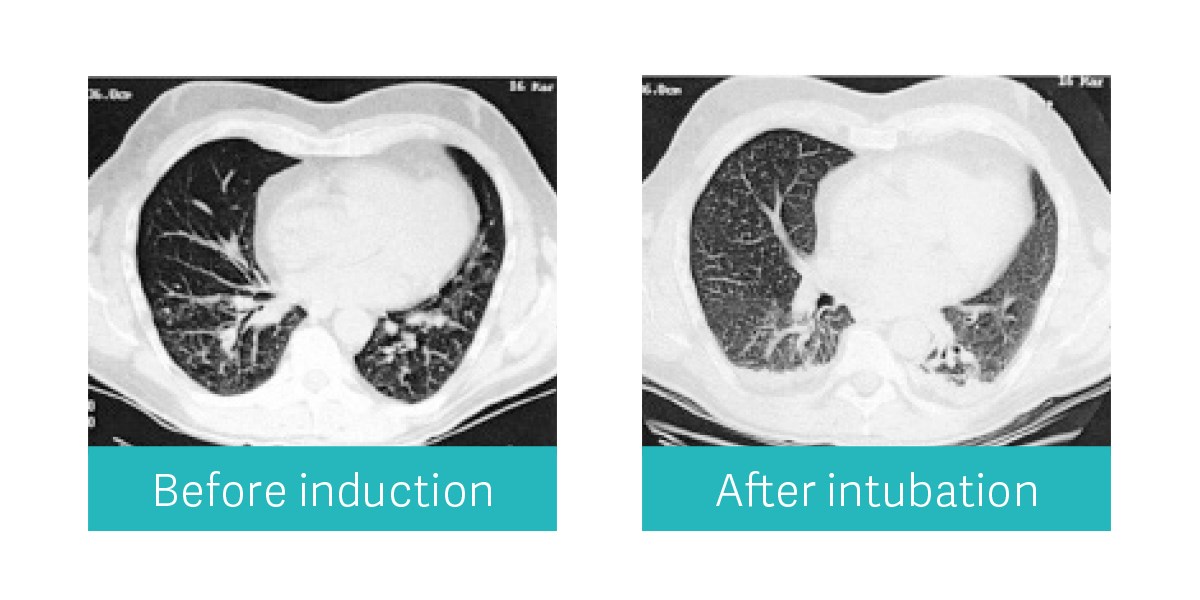Ventilation strategies and hemodynamic monitoring goes hand in hand
