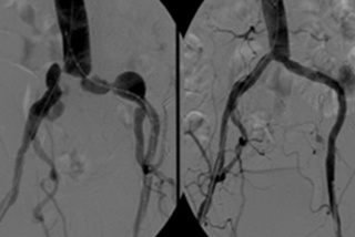 Stents revestidos com expansão por balão Advanta V12 - Getinge