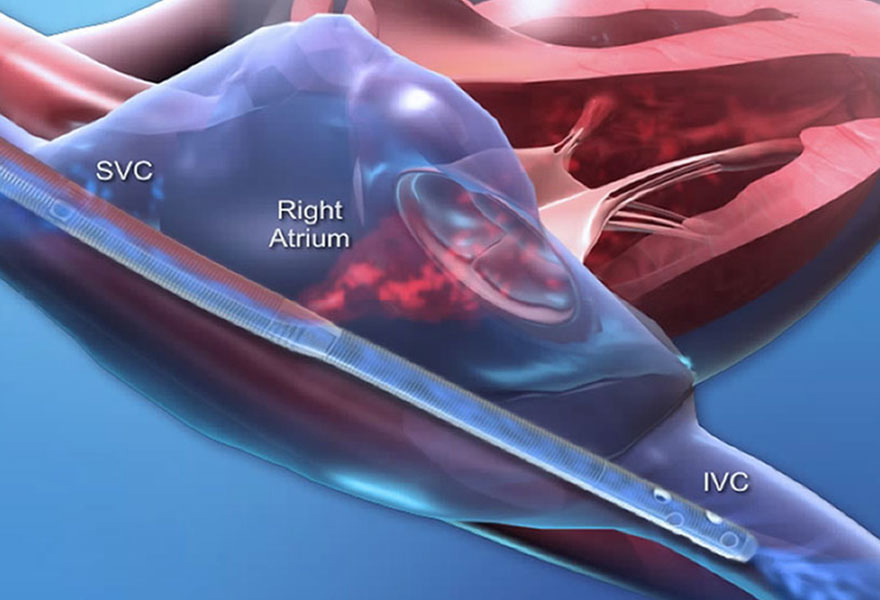 Avalon Elite Bi-Caval Dual Lumen Catheter - Getinge