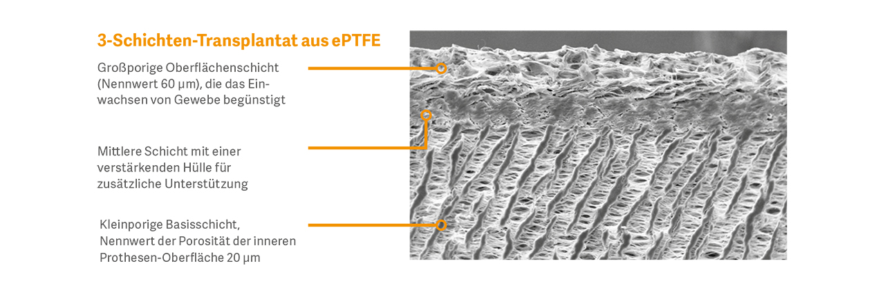 Flixene Gefäßimplantat