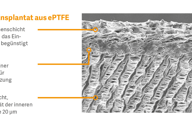 Flixene Gefäßimplantat