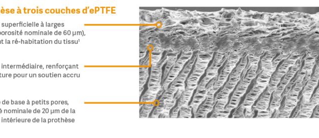 Prothèse vasculaire Flixene - Getinge