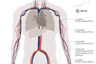 PiCCO Monitoring System – Advanced Hemodynamic Insights - Getinge