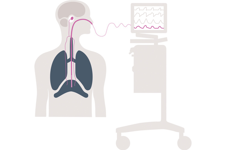 Getinge Servo-u® - le ventilateur mécanique facile à utiliser et le ...