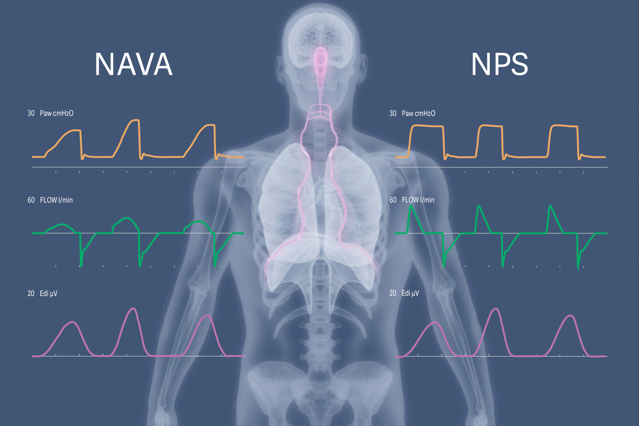 Getinge Servo-u® – das mechanische Beatmungsgerät, das leicht zu ...