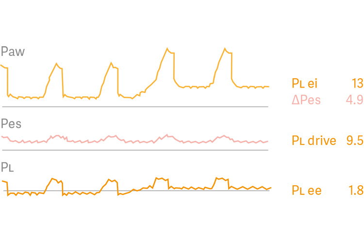 Getinge Servo-u® - the simple to use safer to learn mechanical ventilator - Getinge