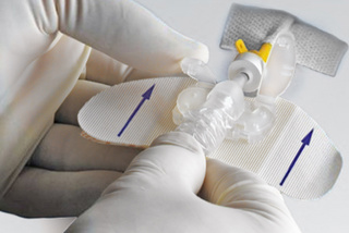 Statlock IAB Stabilization Device - Getinge