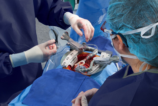 CABG - Coronary Artery Bypass Graft - Getinge 3.0