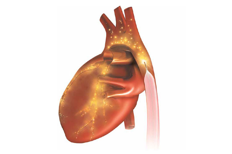 IABP first line support for your high risk patients