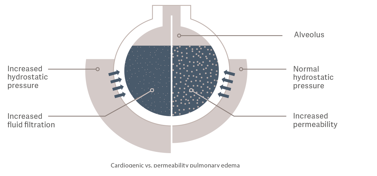 The challenge of ARDS