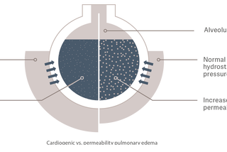 El reto del SDRA - Getinge 3.0