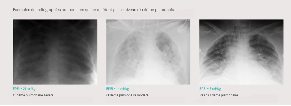 Le défi du SDRA - Getinge