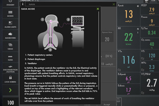 Easy to use mechanical ventilation | Getinge - Getinge